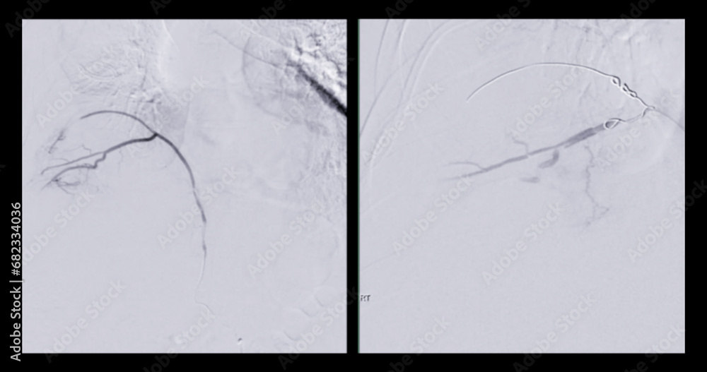 Balloon Angioplasty is a medical procedure used to widen narrowed or ...