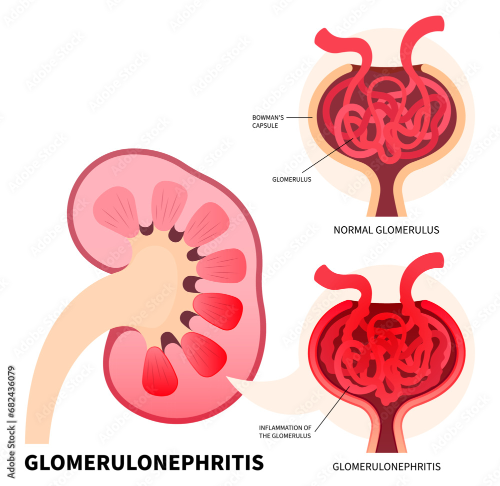 The Glomerulus of kidney disease that show Polycystic cysts and stones ...