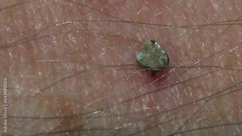 Bee's venom sac. Honey bee stings a man's arm. When the sting is over ...