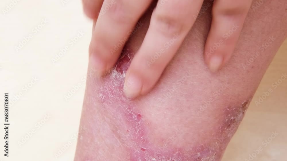 Rash Hives Itchy Skin On Leg Inflammation And Medical Allergies