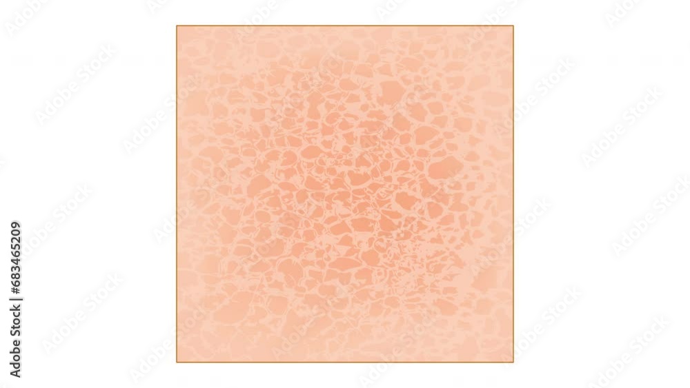 Dry skin. Dehydration of a human skin. Ichthyosis. transepidermal water ...