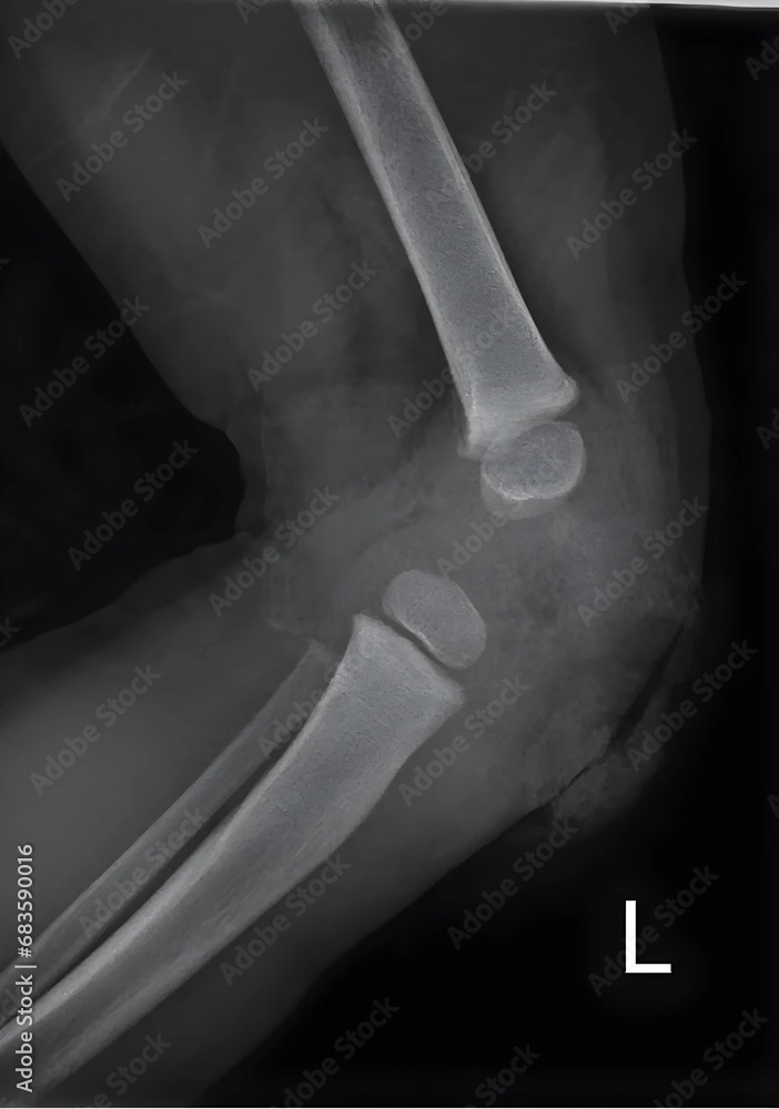 X-ray image showing the lateral view of a pediatric knee joint Stock ...
