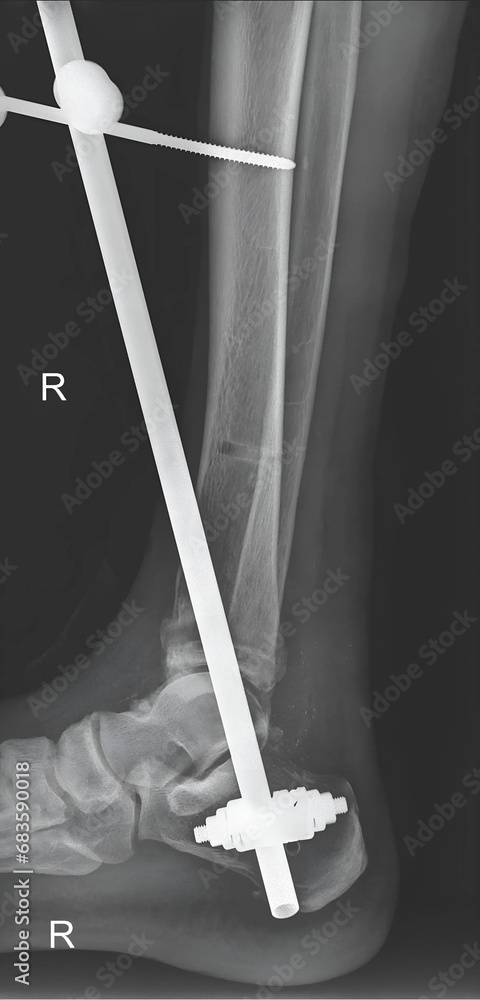 X-ray image showing lower limb external fixation Stock Photo | Adobe Stock