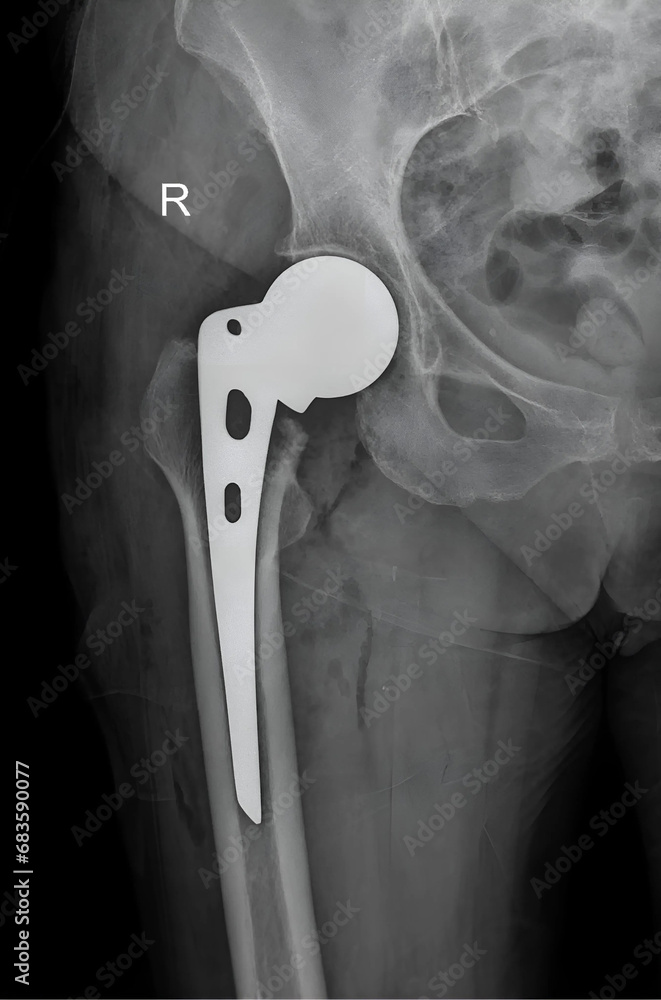 X-ray image of a hip joint replacement involves highlighting the ...
