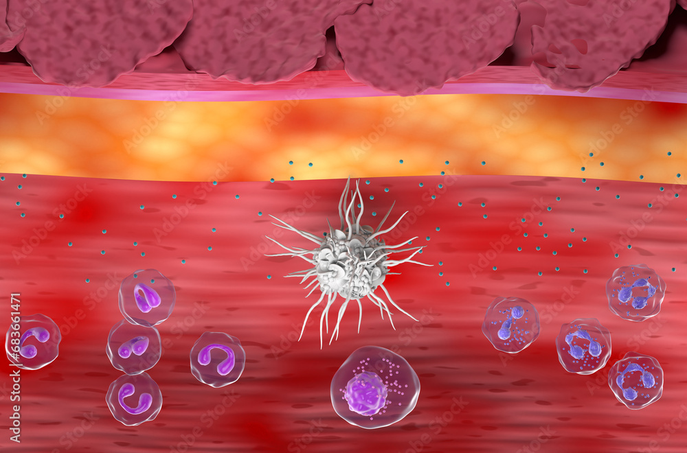 Inflammatory skin in Eczema, Atopic Dermatitis (AD) - top view 3d ...