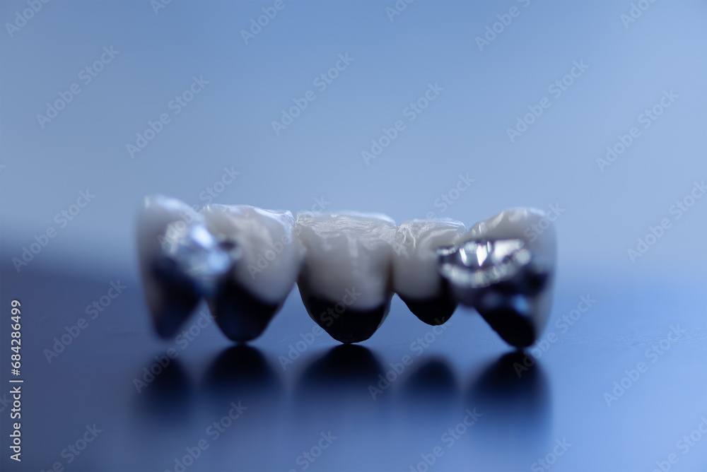Dental teeth dentists model. Models of human jaws in an orthodontic ...