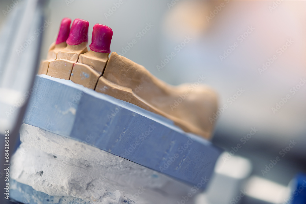 Dental teeth dentists model. Models of human jaws in an orthodontic ...