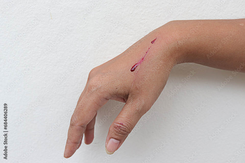 Fresh wound on the hand had blood on the skin. woman's red mark was ...