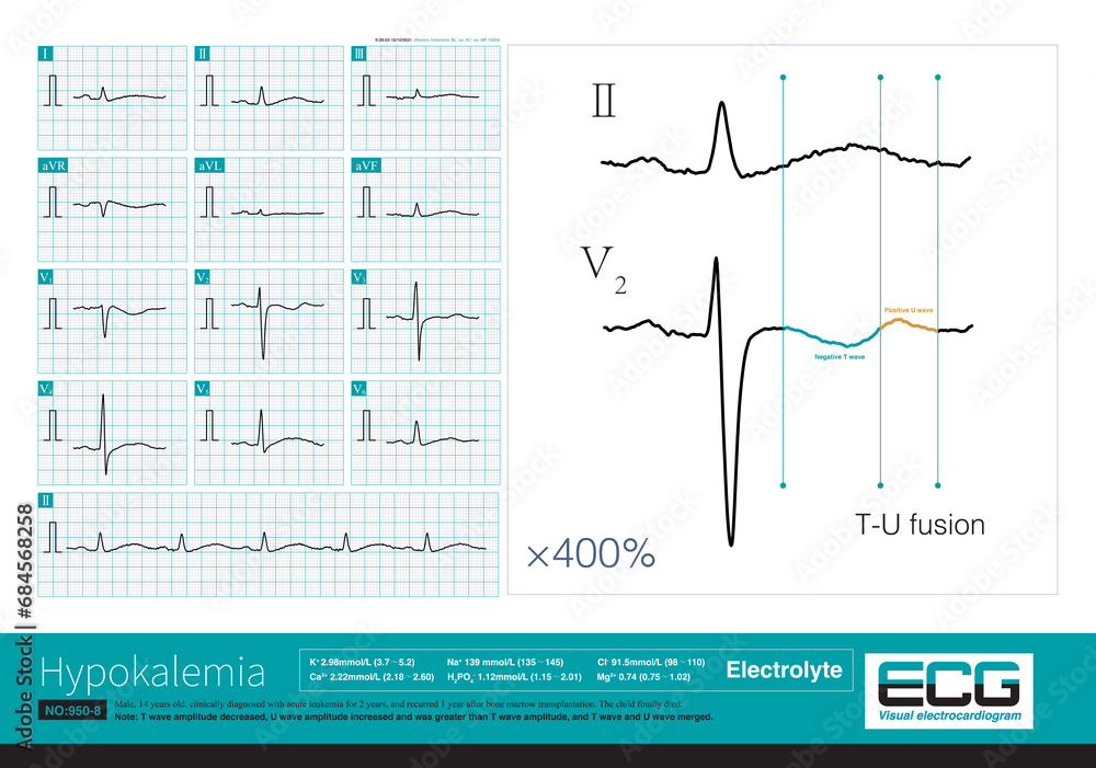 Female 5 year old Clinically Diagnosed With Dextrocardia The female-5-year-old-clinically-diagnosed-with-dextrocardia-the