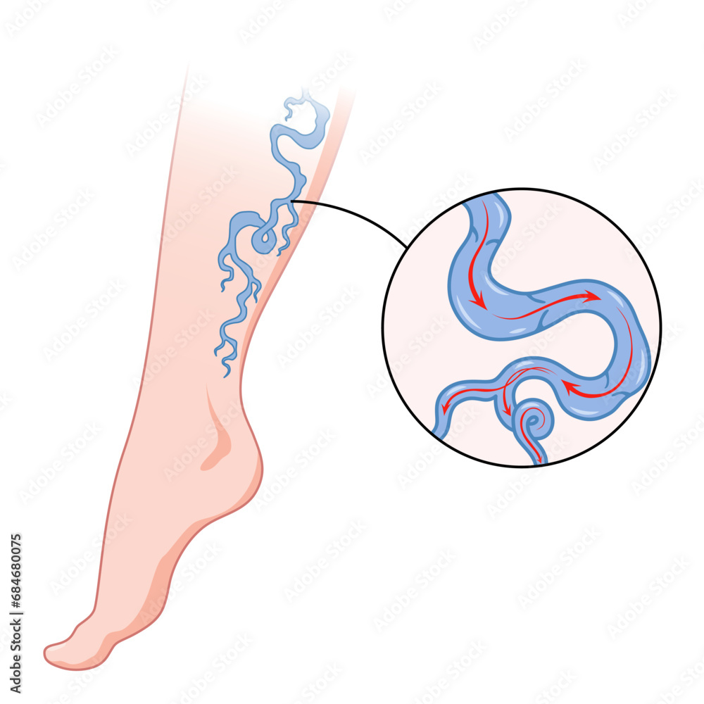 Varicose veins. Blue blood vessel visible through the skin, abnormally ...