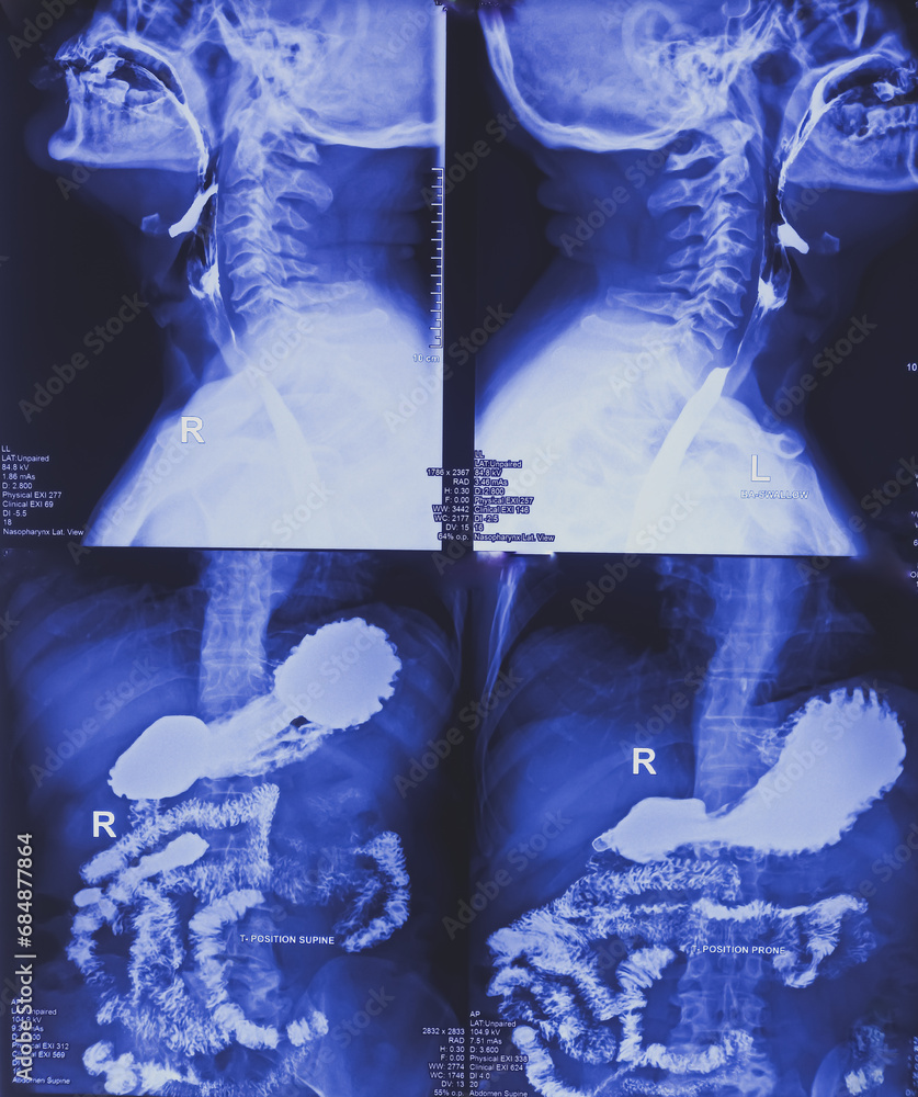 Barium swallow of oesophagus examination x-ray. showing upper digestive ...
