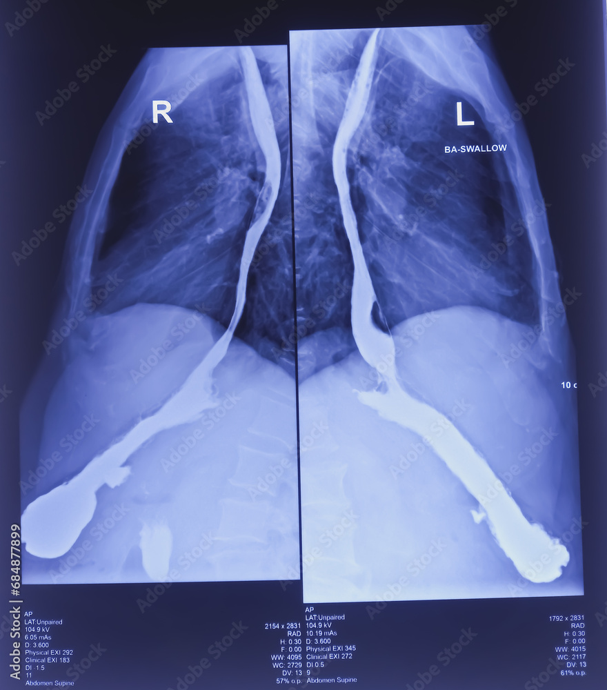 Barium swallow of oesophagus examination x-ray. showing upper digestive ...