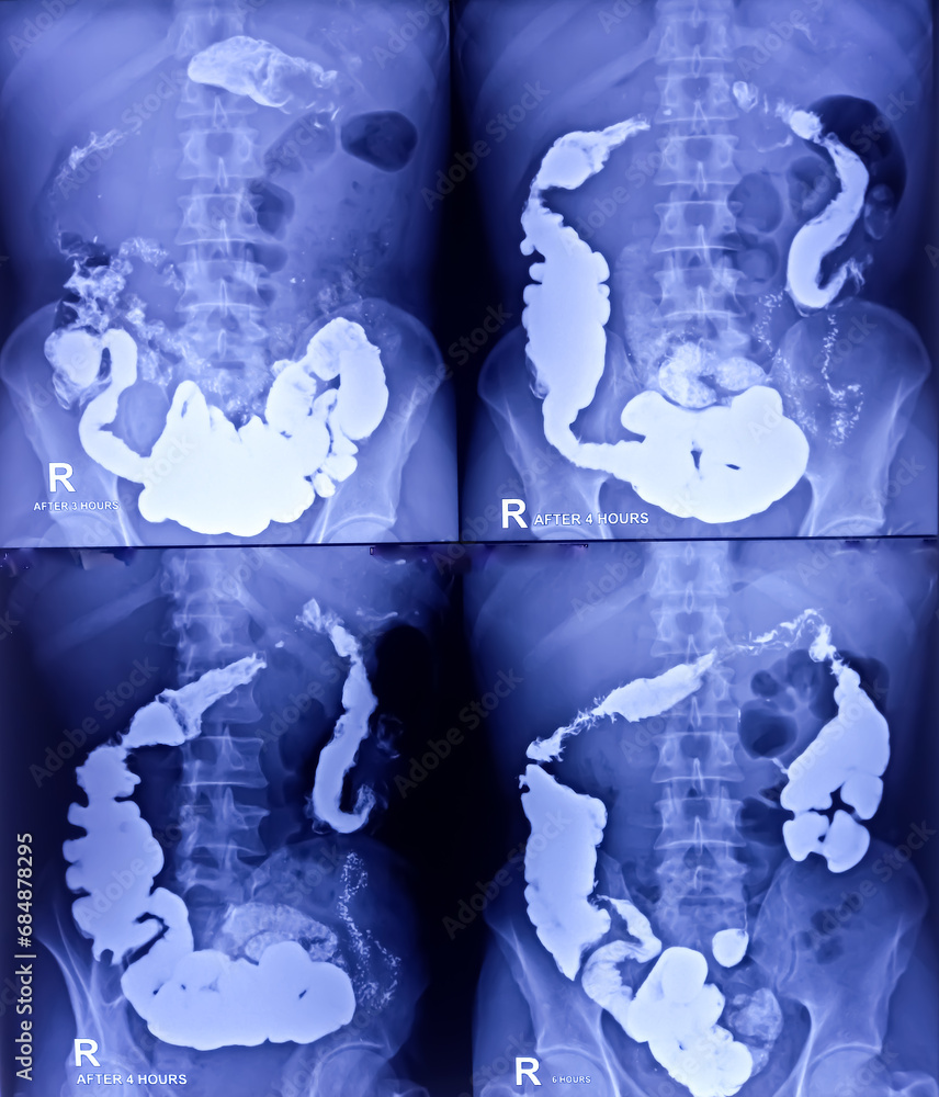 Barium swallow of oesophagus examination x-ray. showing upper digestive ...