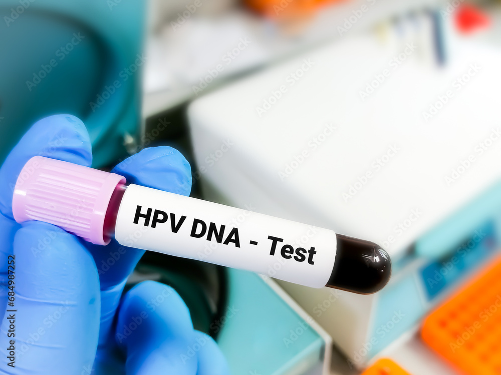 Blood sample on doctor hand for Human Papilloma Virus (HPV) DNA PCR ...