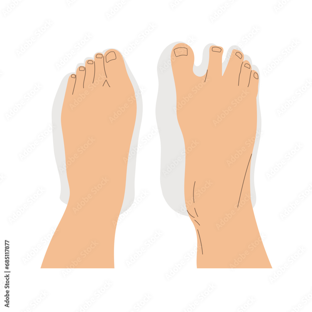 Top view comparison of healthy and deformed feet after wearing regular ...