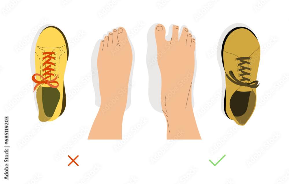 Top view comparison of healthy and deformed feet after wearing regular ...