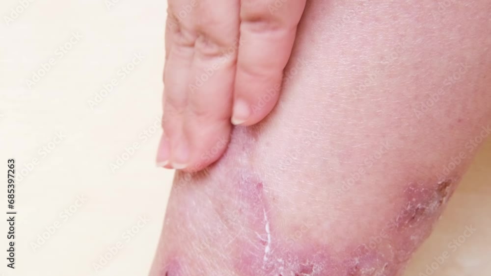 hand applies ointment to wounds, rash, hives, itchy skin on leg ...