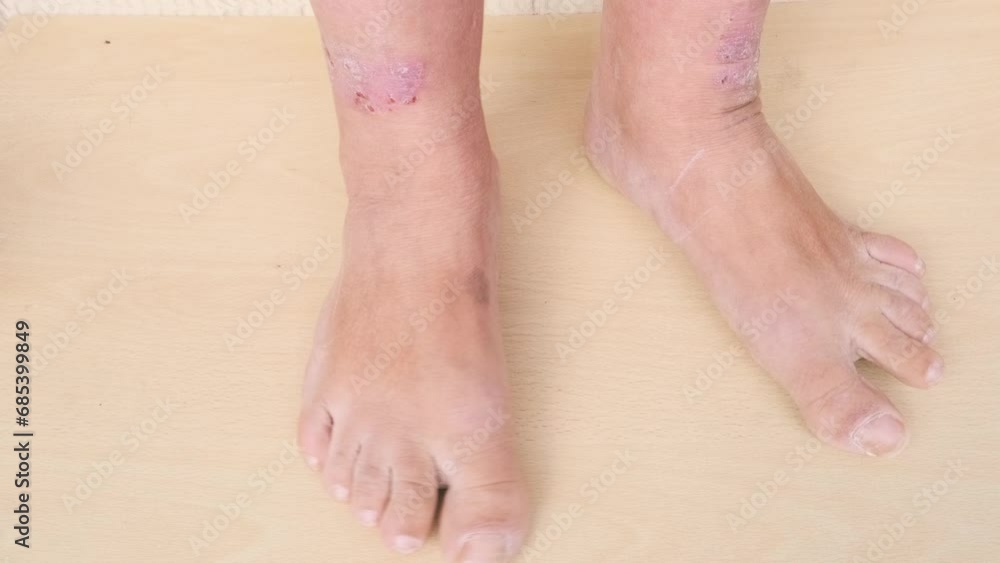 rash, hives, itchy skin on legs, inflammation and Medical Allergies ...