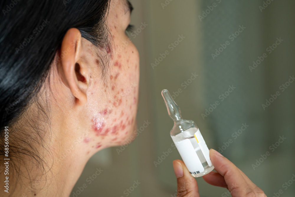 Acne on face because the disorders of sebaceous glands productions ...