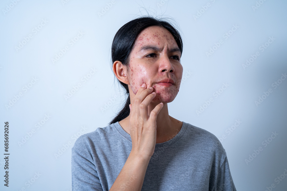 Acne on face because the disorders of sebaceous glands productions ...