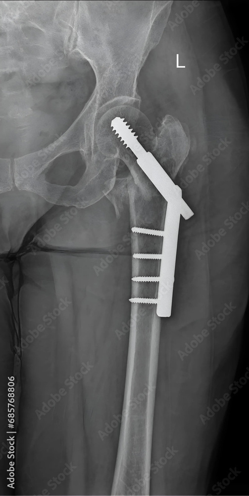 X-ray provides a focused view of the hip region where a Dynamic Hip ...