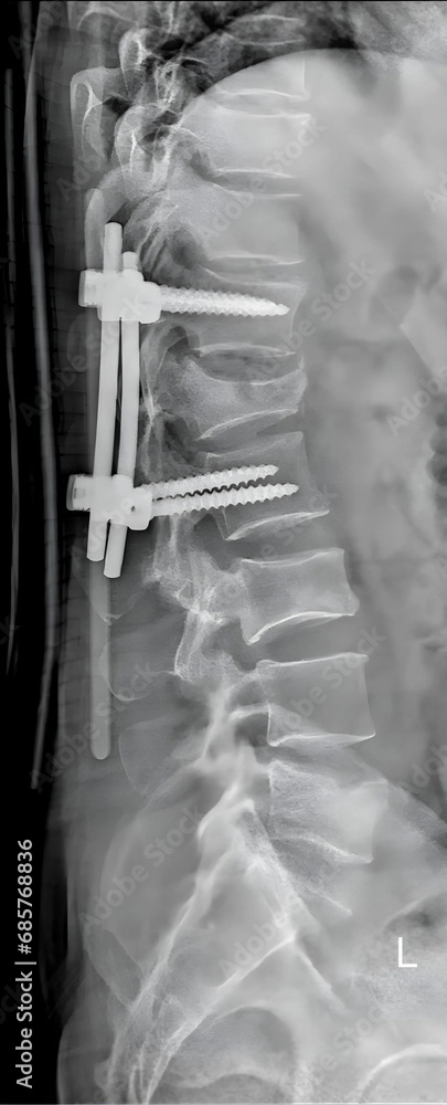 X-ray image of the lumbar spine in a lateral view with fracture ...