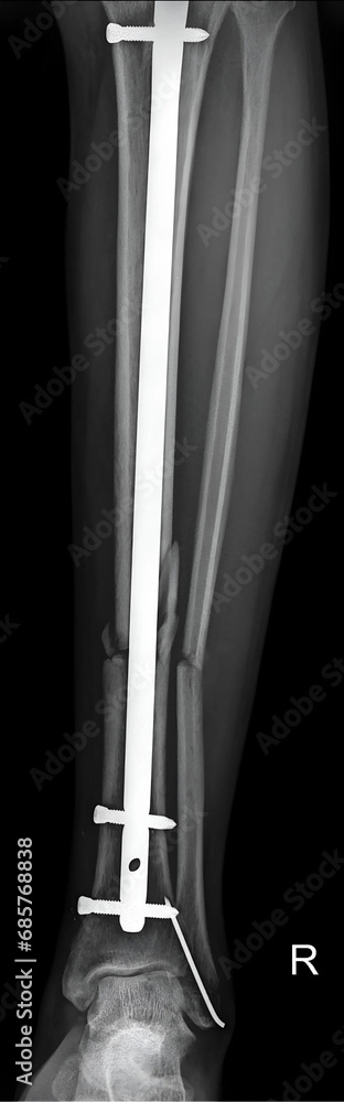 X-ray image of the tibia with an intramedullary (IM) nail shows a ...