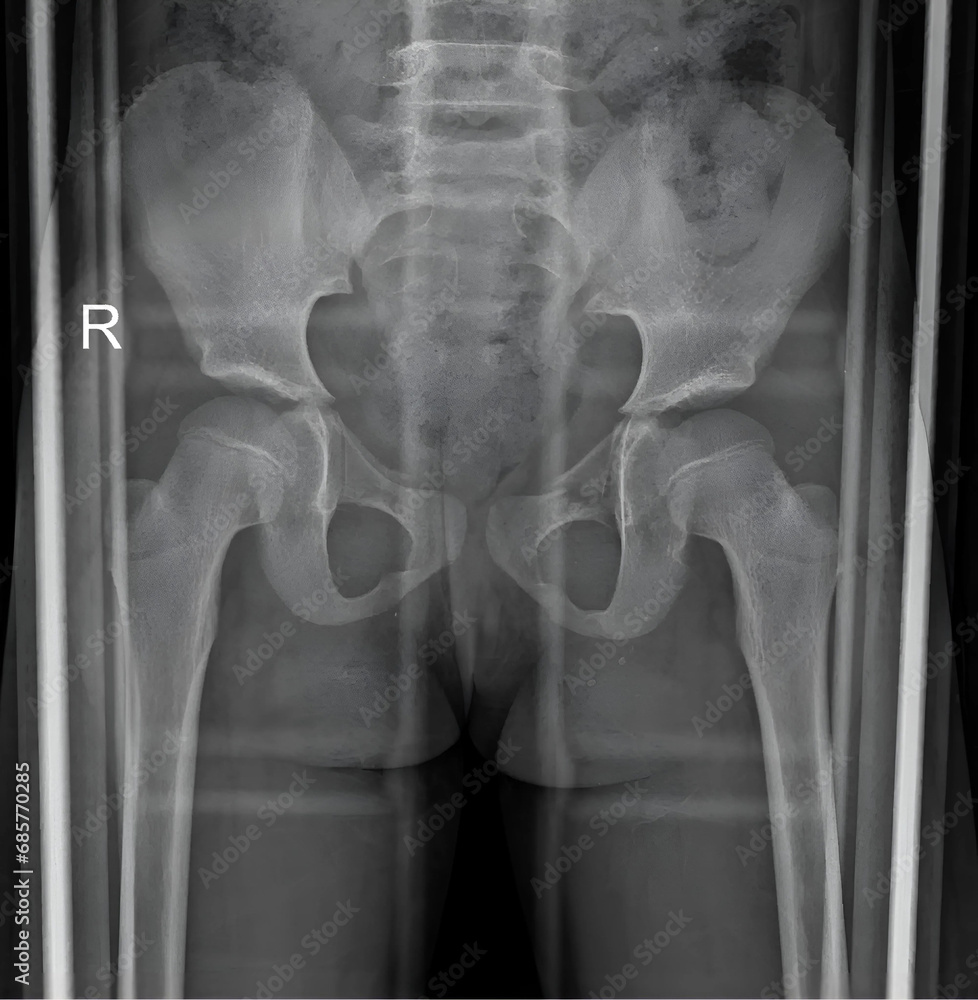 X-ray captures the pediatric pelvis, revealing a fracture that bespeaks ...