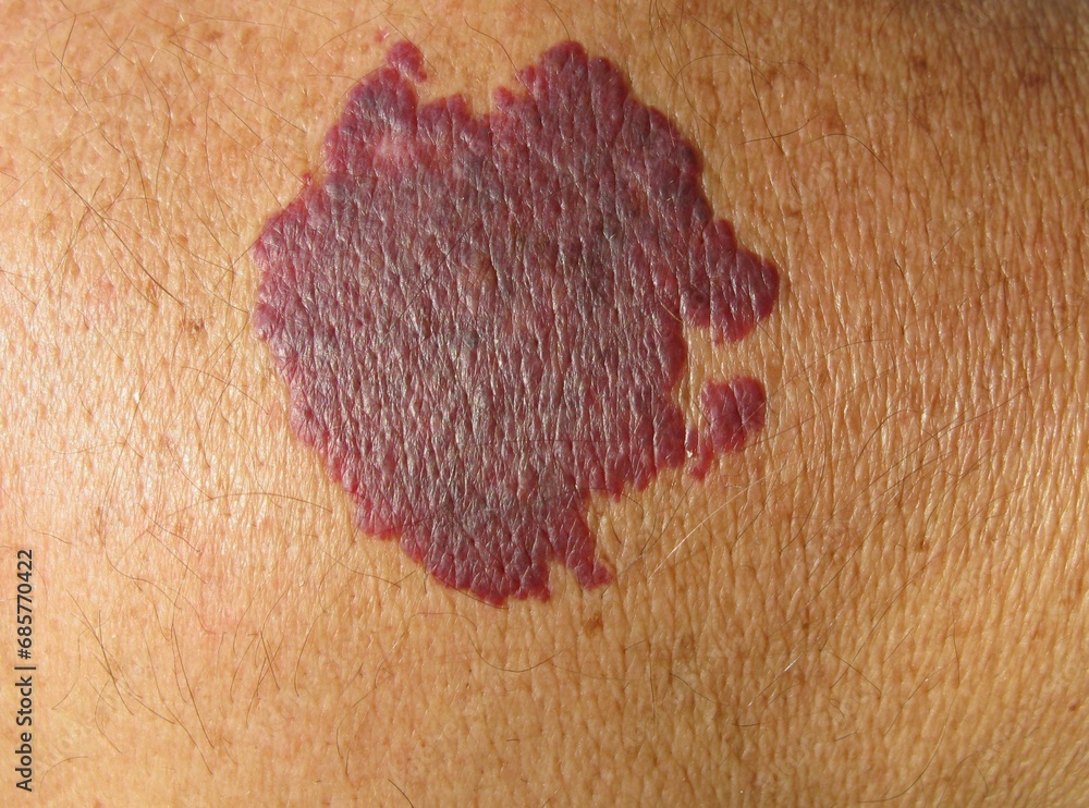 A port-wine stain or naevus flammeus is a vascular birthmark consisting ...