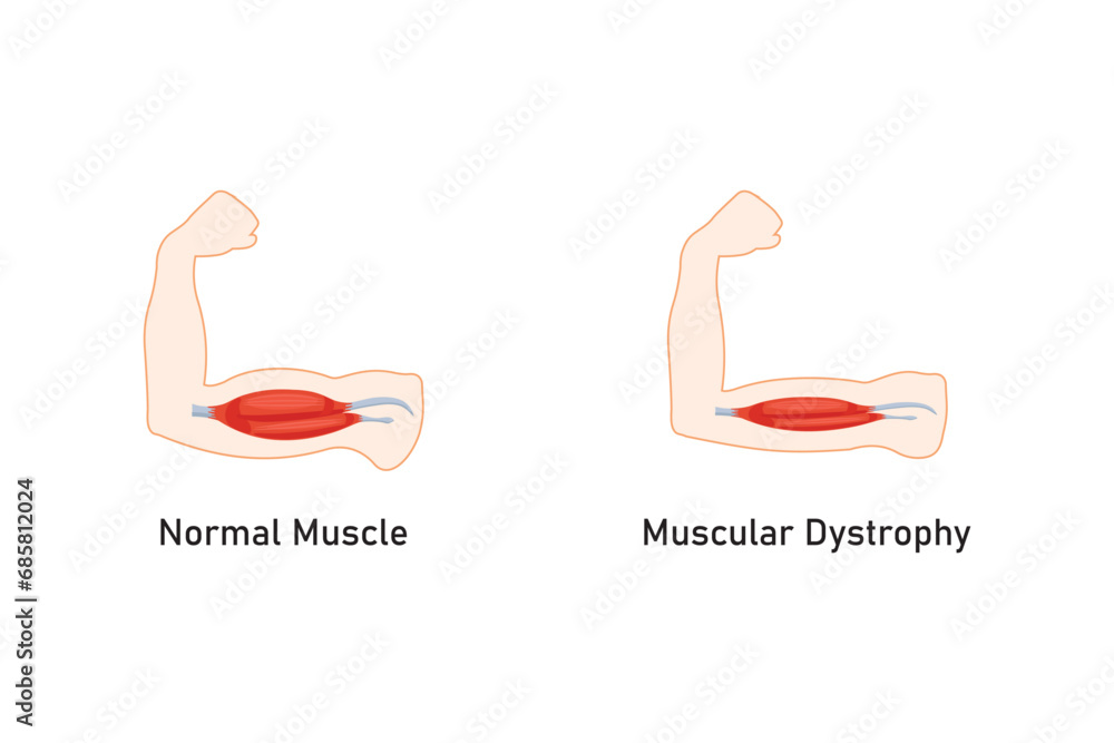 Duchenne Muscular Dystrophy (DMD) Scientific Design. Vector ...