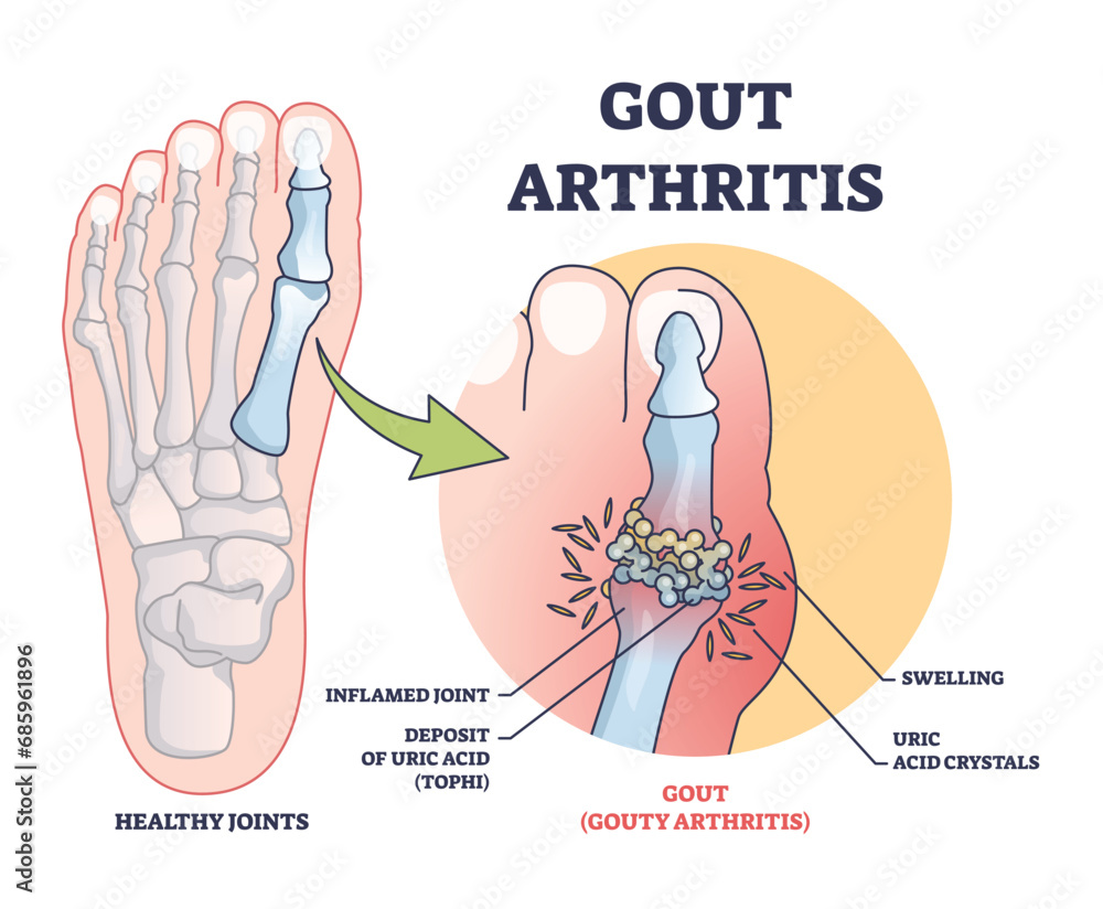 Gouty arthritis with inflamed toe joint painful condition outline diagram. Labeled educational ...