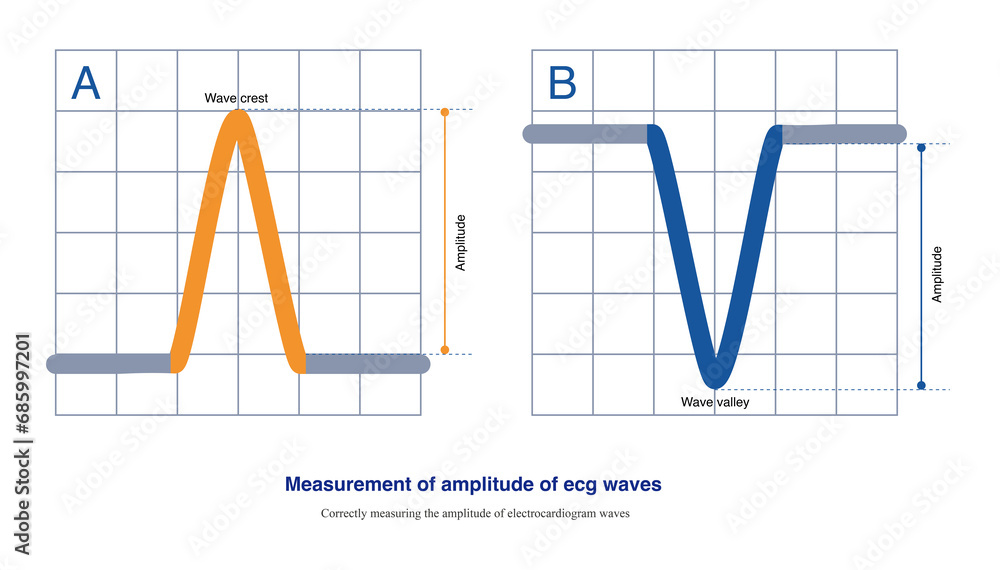 When the polarity of the ECG wave is different, there are two methods ...