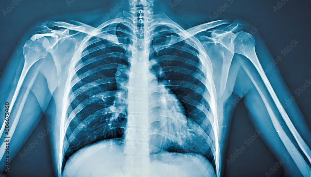 X-ray images of the chest and lung with two toning Stock Photo | Adobe ...