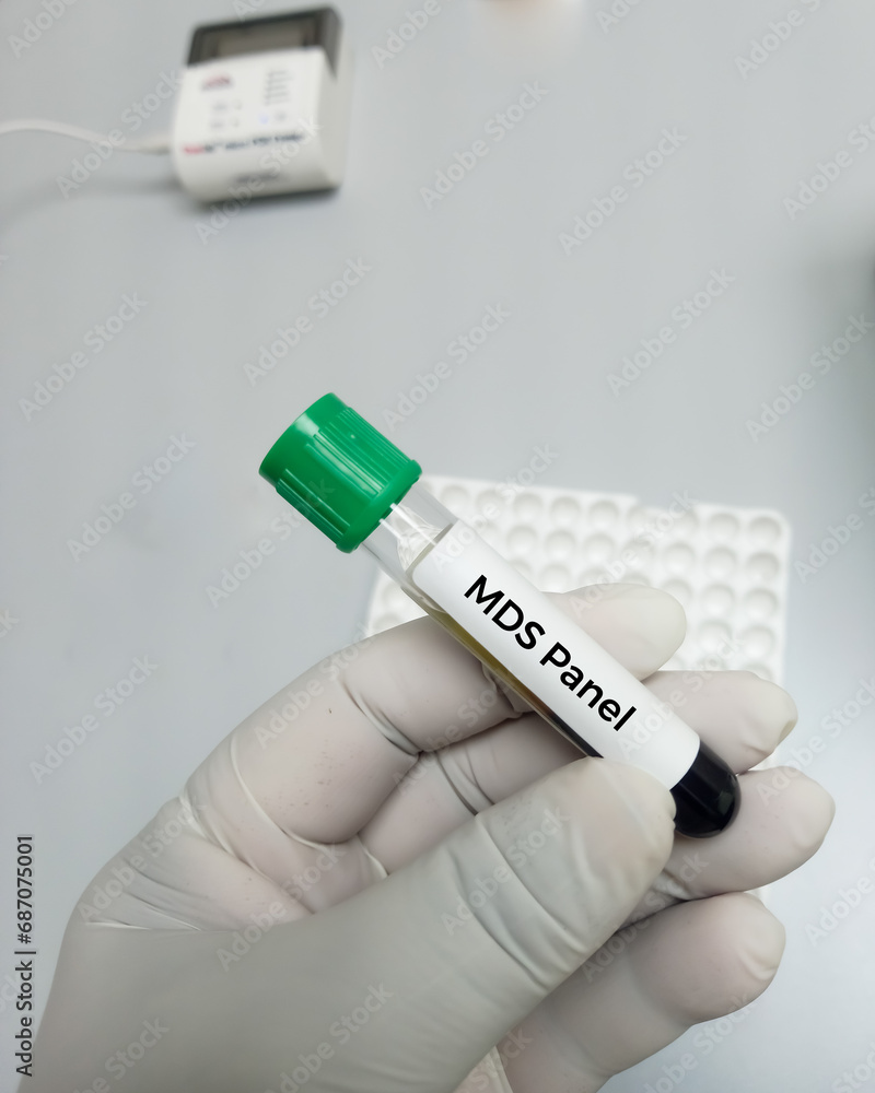 Foto de Blood sample for Myelodysplastic syndrome test. To diagnose MDS ...