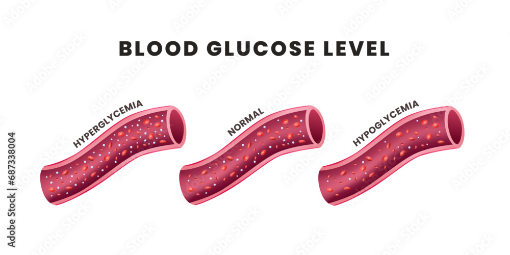 Glucose in blood vessel. glucose level, hyperglycemia hypoglycemia ...