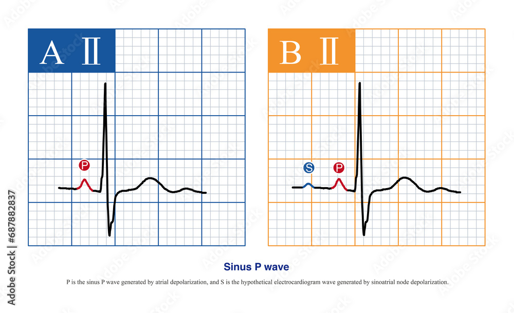 Under normal circumstances, the sinus P wave is the first ECG wave, as ...