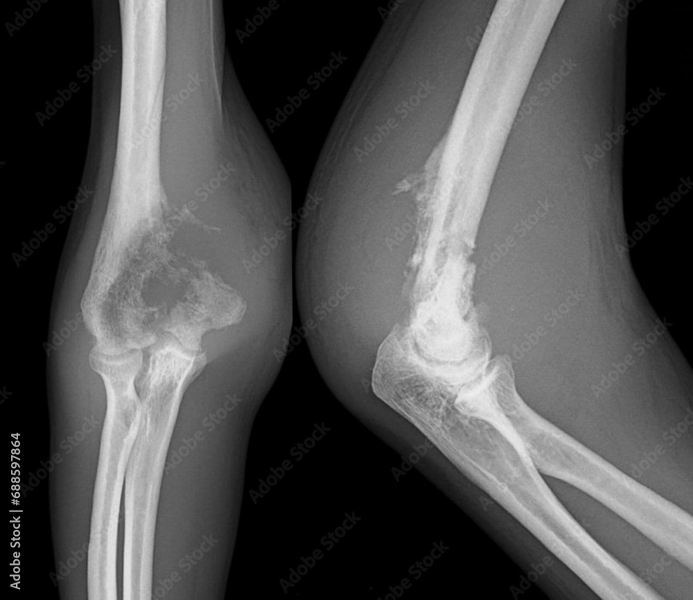 osteosarcoma xray elbow bone tumor Stock Photo | Adobe Stock