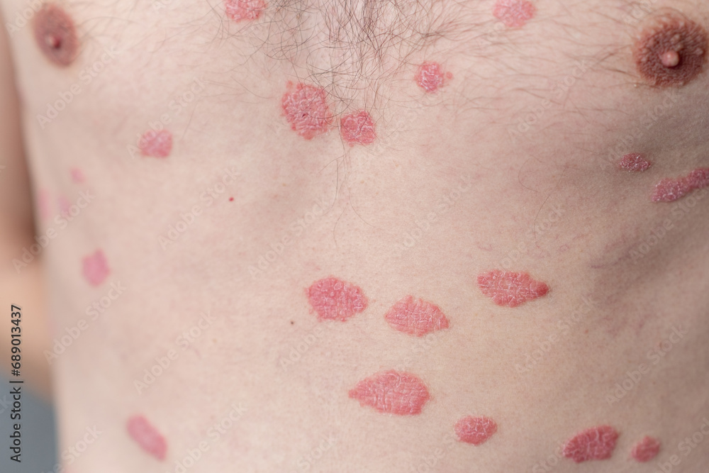 Psoriasis Vulgaris, skin patches are typically red, itchy, and scaly ...