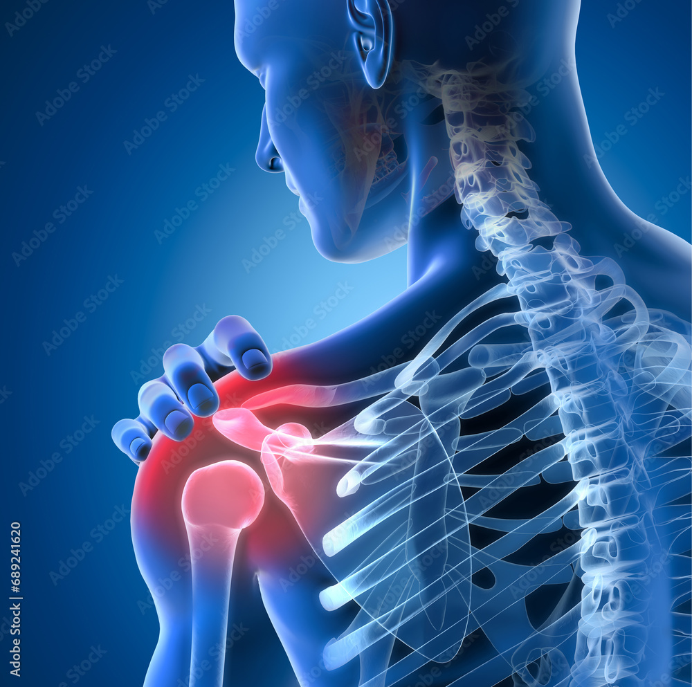 Painful shoulder joints. Frozen shoulder, Impingement. 3D illustration ...