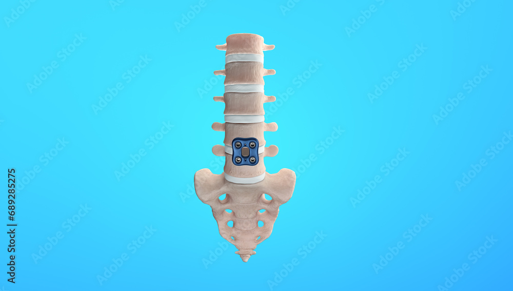 Orthopedic Spine Fixation Spinal Fixator Anterior Lumbar Plate Stock ...