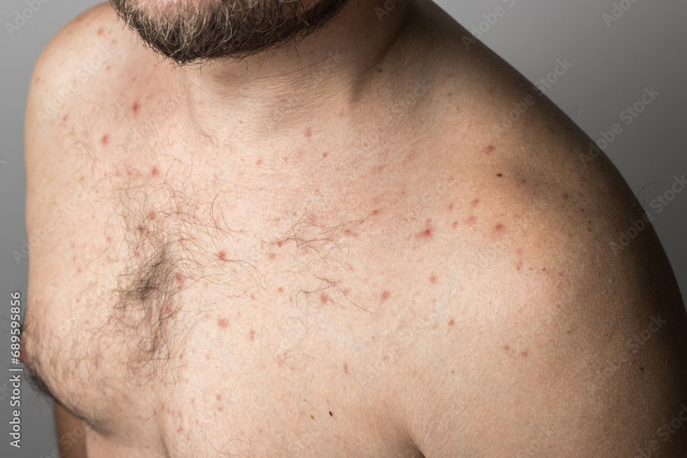 Naked man with red pimples on his chest, acne skin disease, dermatology ...