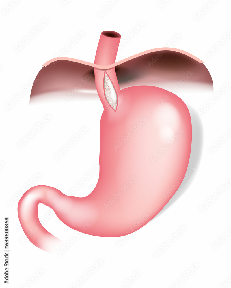 Laparoscopic Heller Myotomy Procedure Cardiomyotomy. Surgery for ...