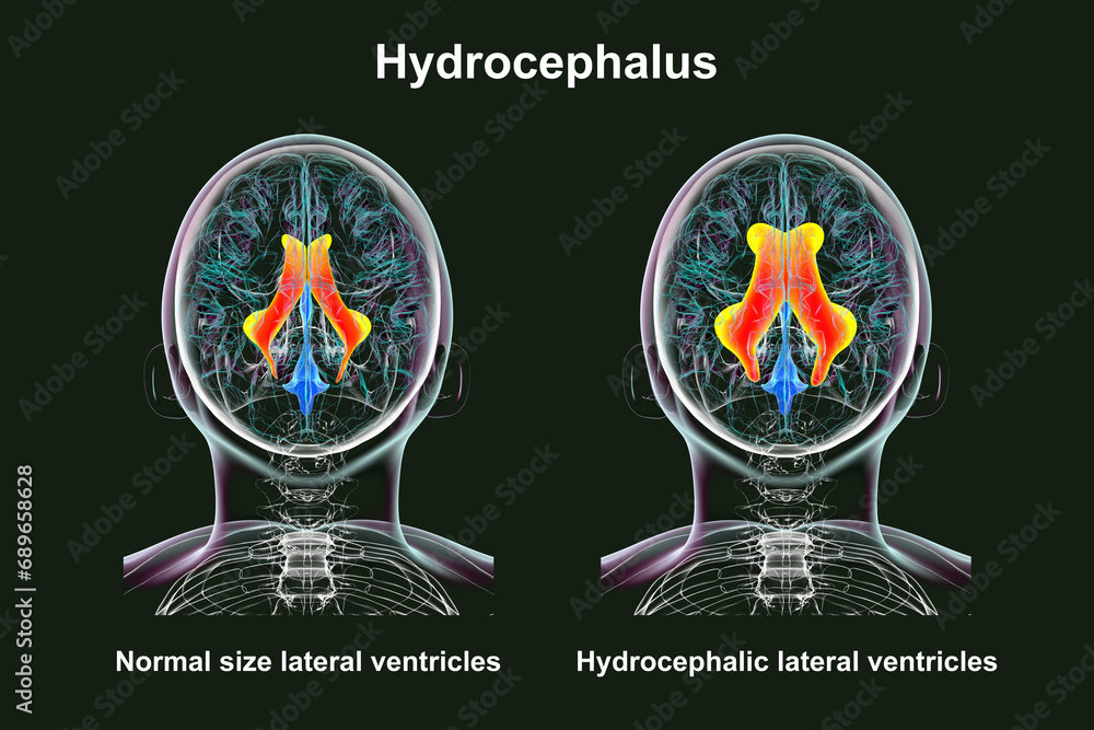 Enlarged and normal lateral ventricles, 3D illustration Stock ...