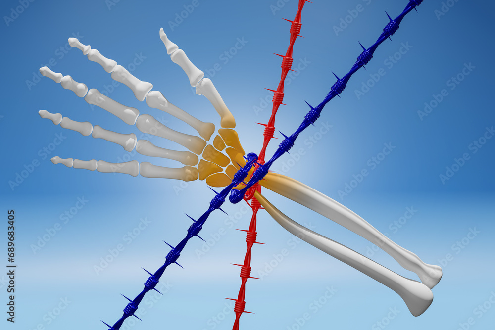 Human wrist bone wrapped around barbed wire. Description of extreme ...