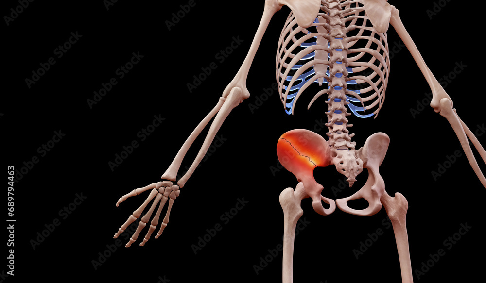 3d rendered illustration of a human skeleton suffering a pelvic hip ...