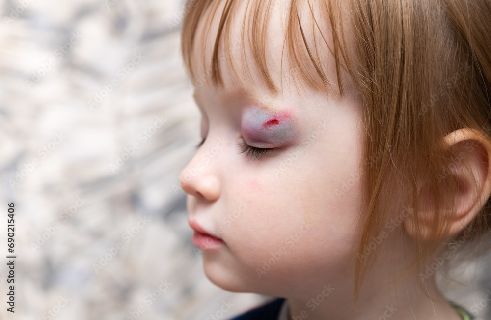 Bruise and swelling above the child's eye. Injury to the eyelid from a blow. Accident. Closeup ...