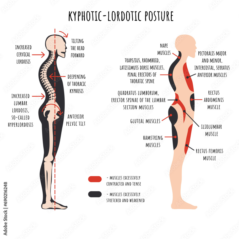 Vetor De Posture Disorders Infographic Kyphotic Lordotic Posture The