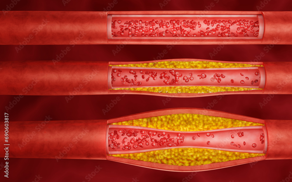 Set of Hyperlipidemia or arteriosclerosis. Blocked artery concept and ...