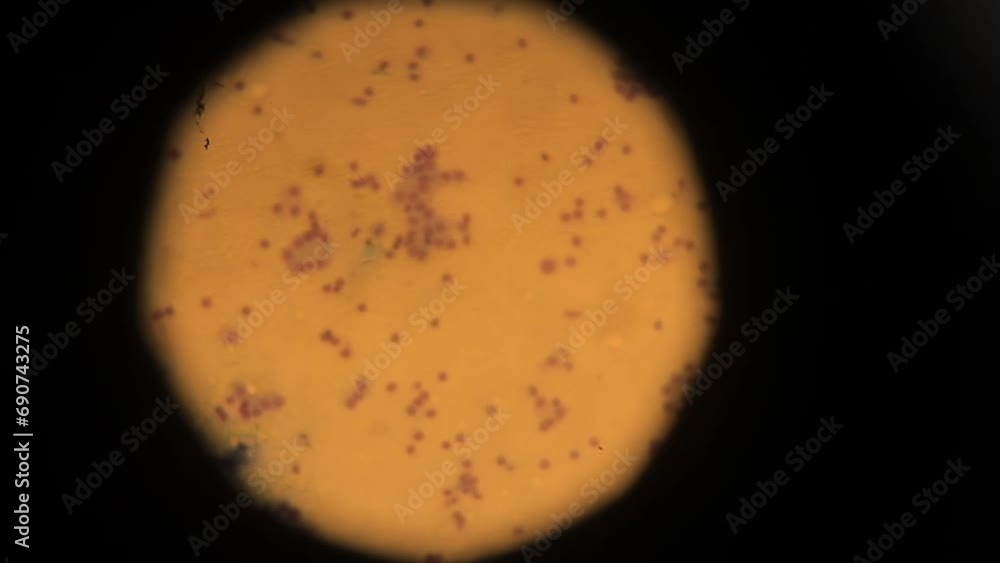 biopsy. biopsy results under a microscope. Human cancer cells under a ...