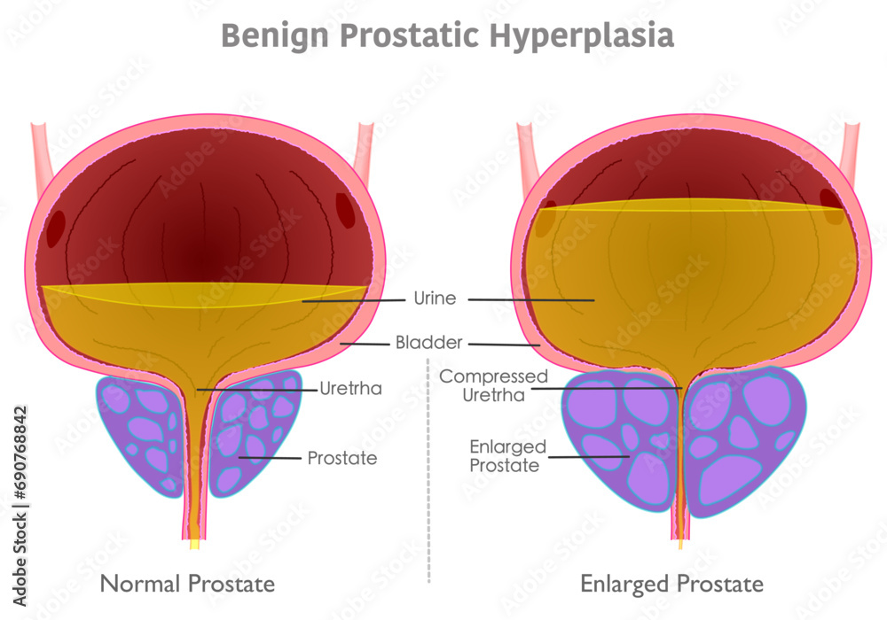 Benign prostatic hyperplasia anatomy. Enlarged, normal prostate, cancer ...